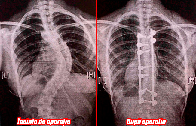 A Crescut Cu 5 Centimetri După Ce I-au îndreptat Coloana | Libertatea