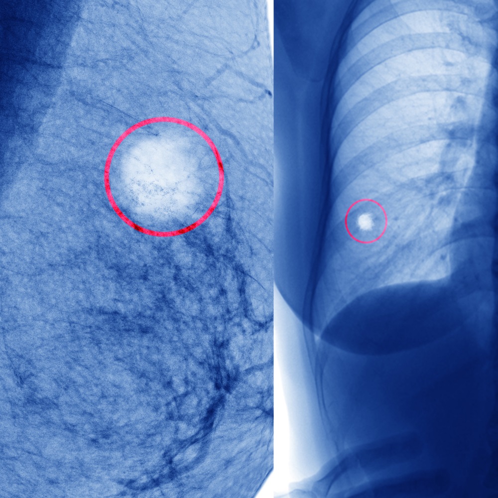 CARE SUNT FACTORII DE RISC AI CANCERULUI DE SÂN | Libertatea